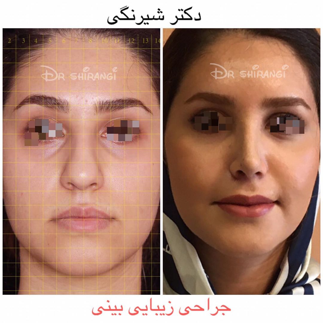 NOSE job IN IRAN(rhinoplasty) - drshirangi